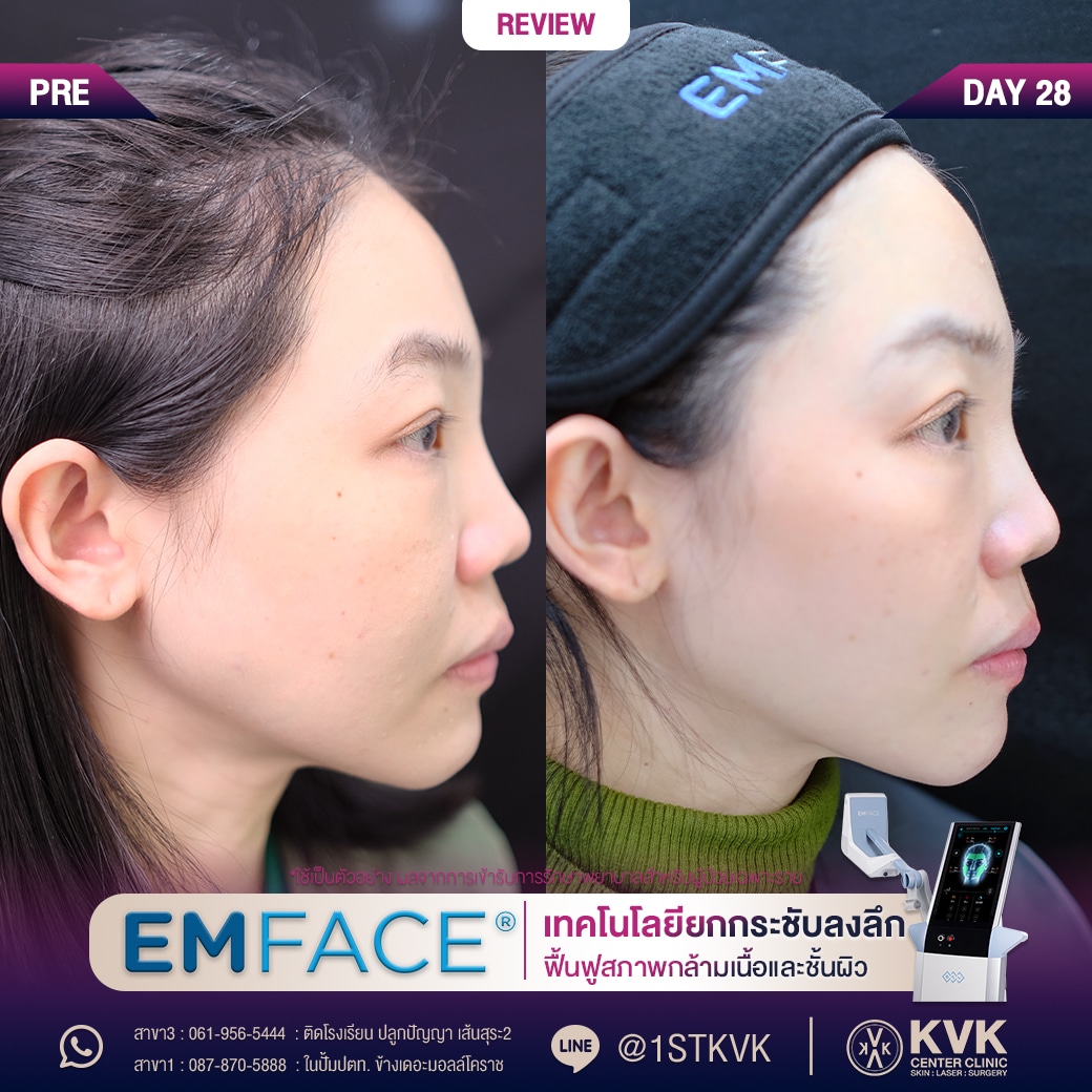 Emface - KVKClinic (เควีเคคลินิก)